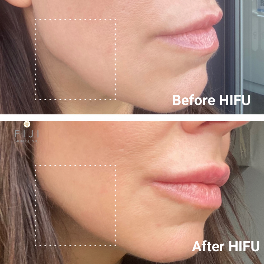 What is a HIFU Treatment? · What Does HIFU Do To Your Face?