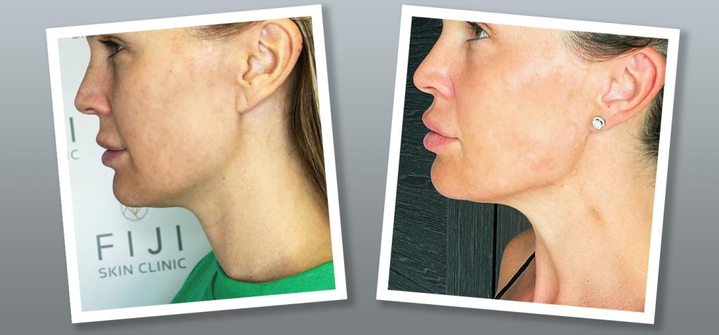 What Fitzpatrick Skin Type am I? · Fiji Skin Clinic