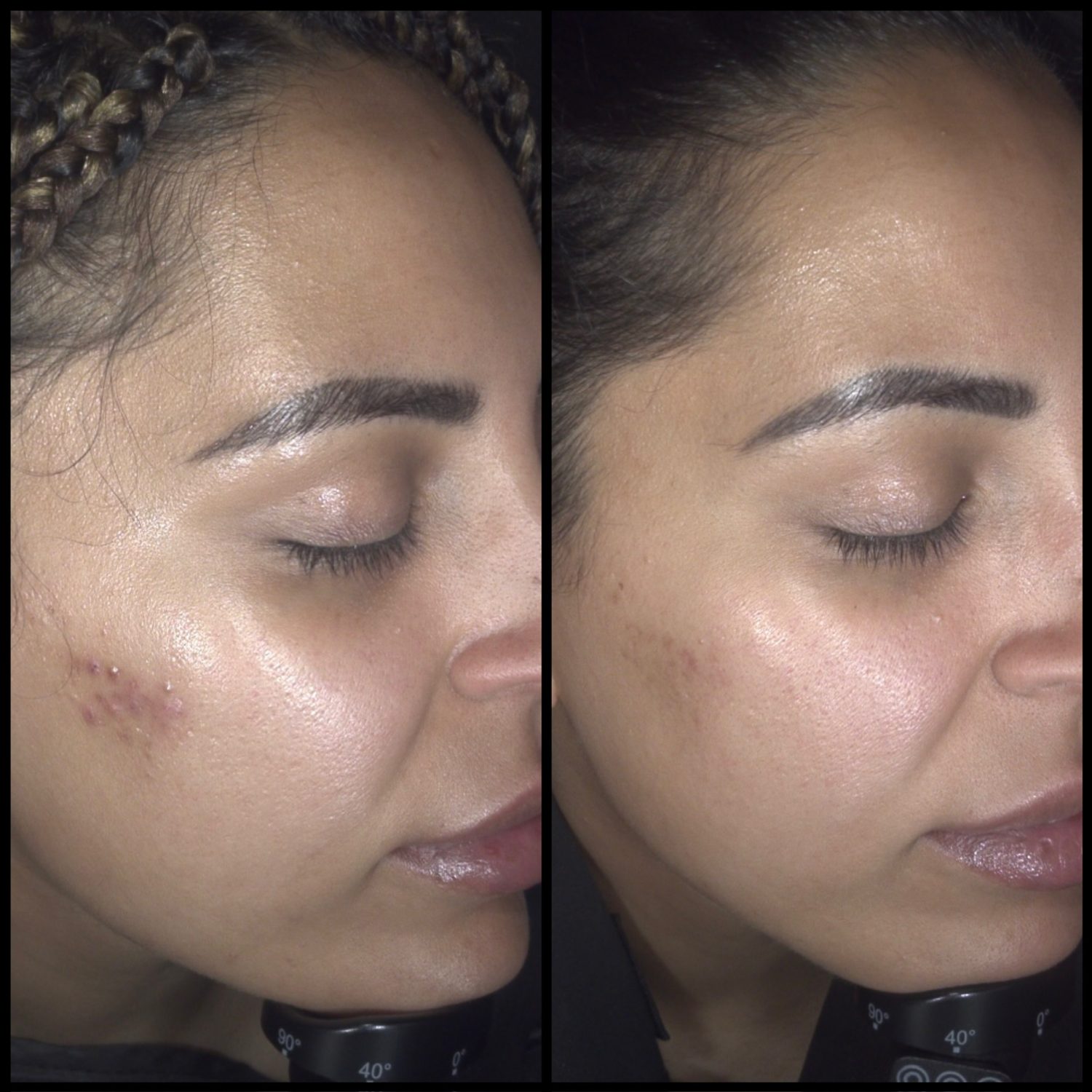 Skin Consultation Birmingham, Sutton Coldfield · Fiji Skin Clinic