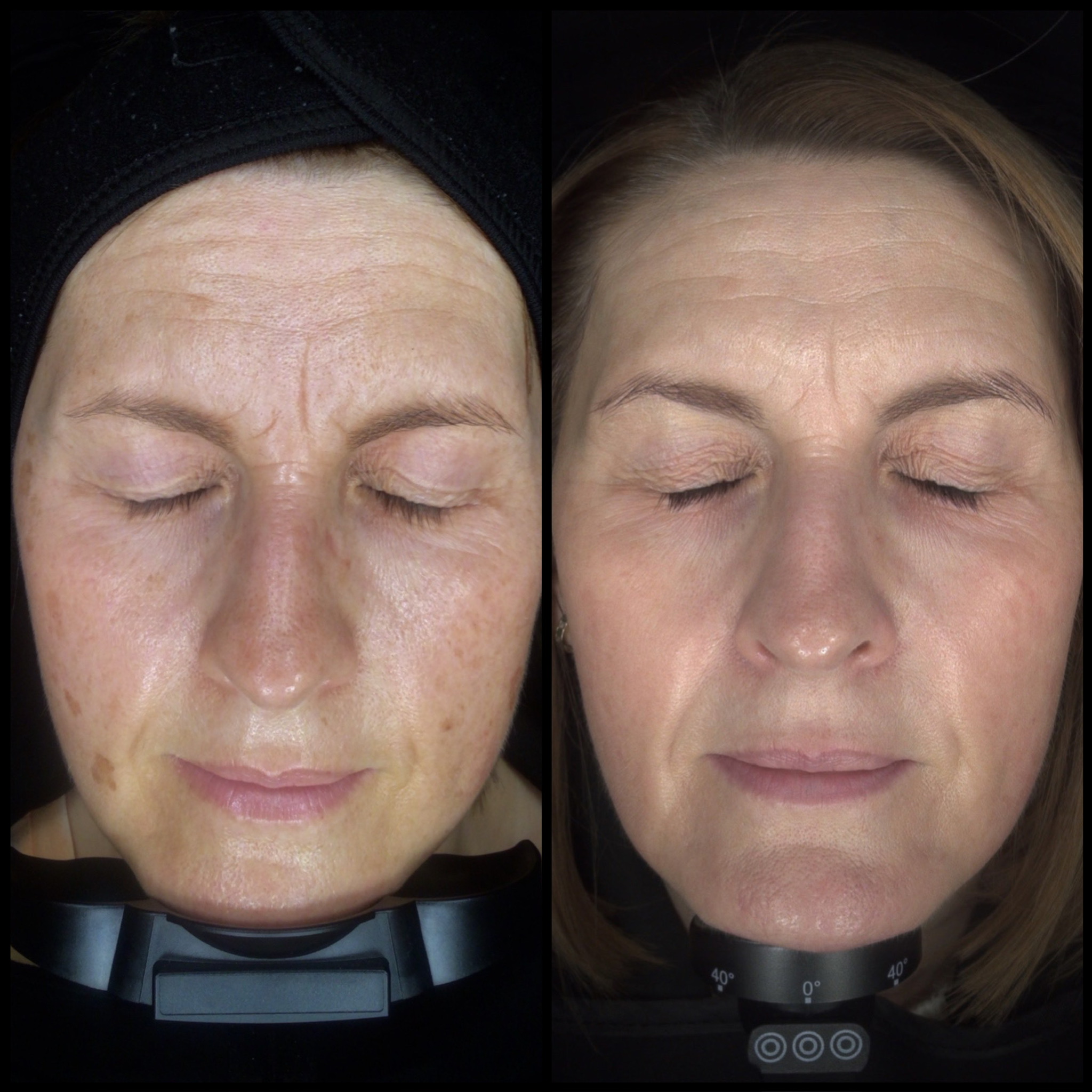 Skin Consultation Birmingham, Sutton Coldfield · Fiji Skin Clinic