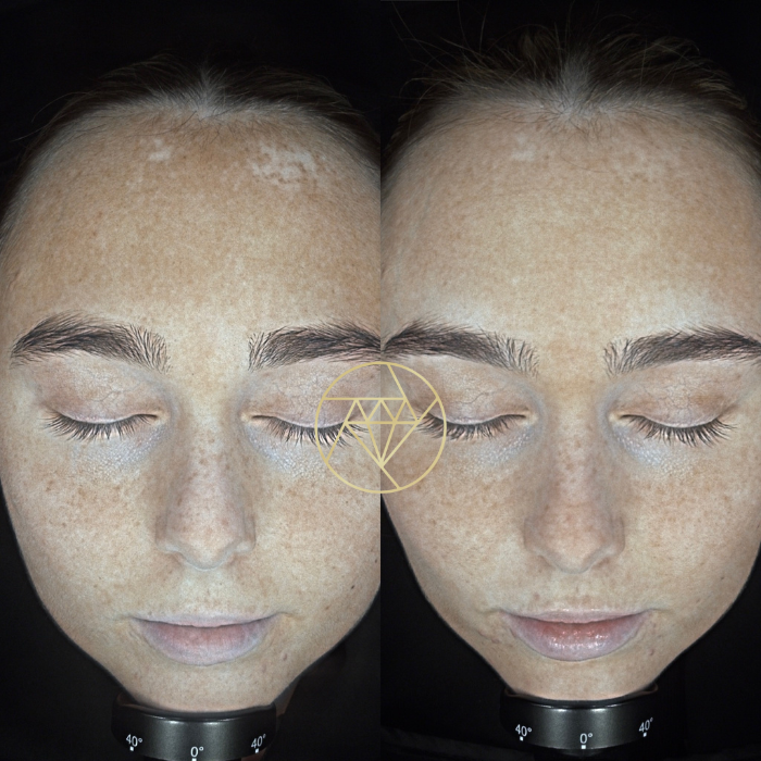 Harmony Clear Lift Treatment · Fiji Skin Clinic