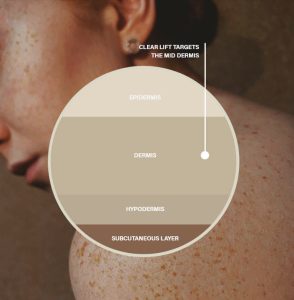 ClearLift Pro Laser Treatment Birmingham | Non-Surgical Face Lift ...